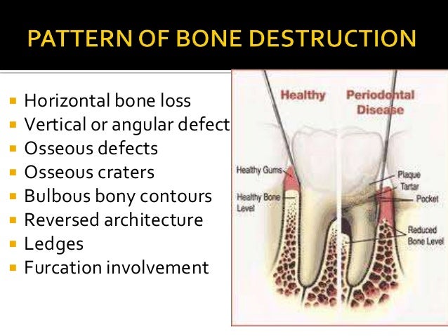 Bone destruction Periodontics *(ViRa)*