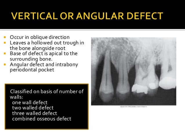 Bone destruction Periodontics *(ViRa)*