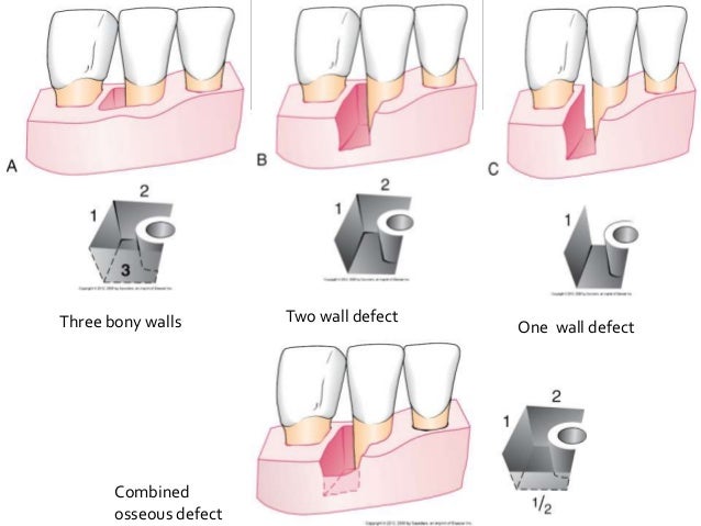Bone destruction Periodontics *(ViRa)*