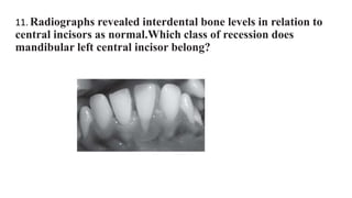 PERIODONTICS Questions related to etiopathogenesis.pptx