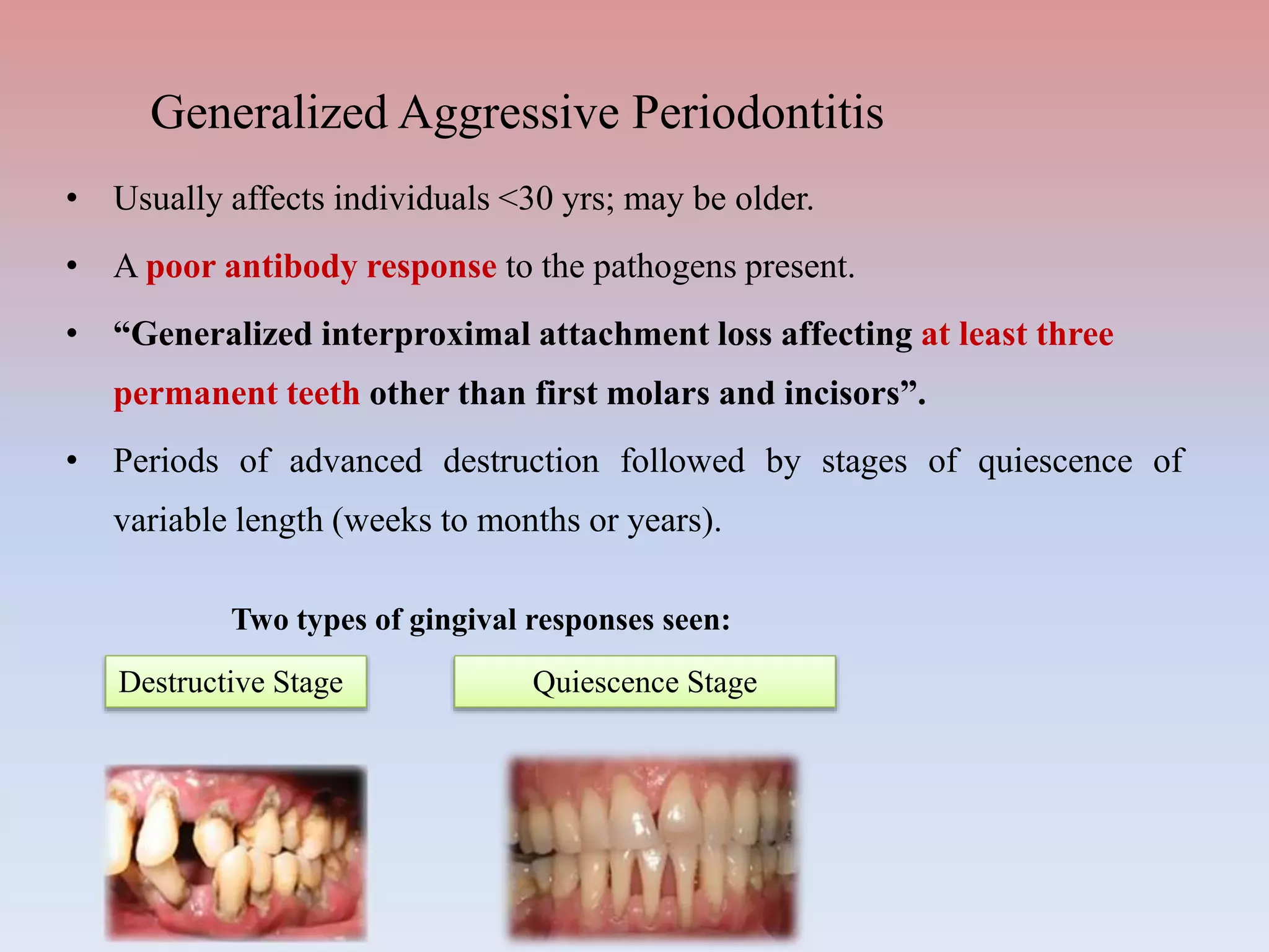 Periodontitis | PPTX