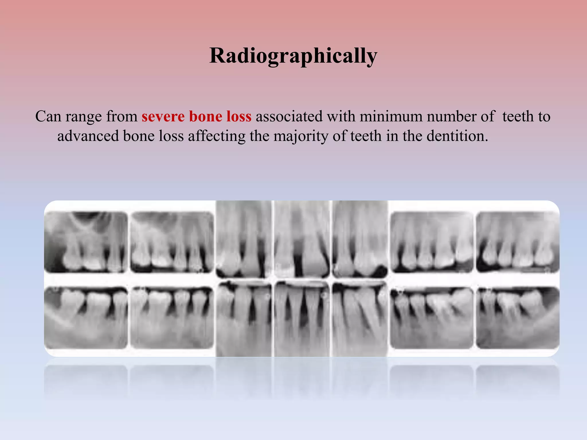 Periodontitis | PPTX