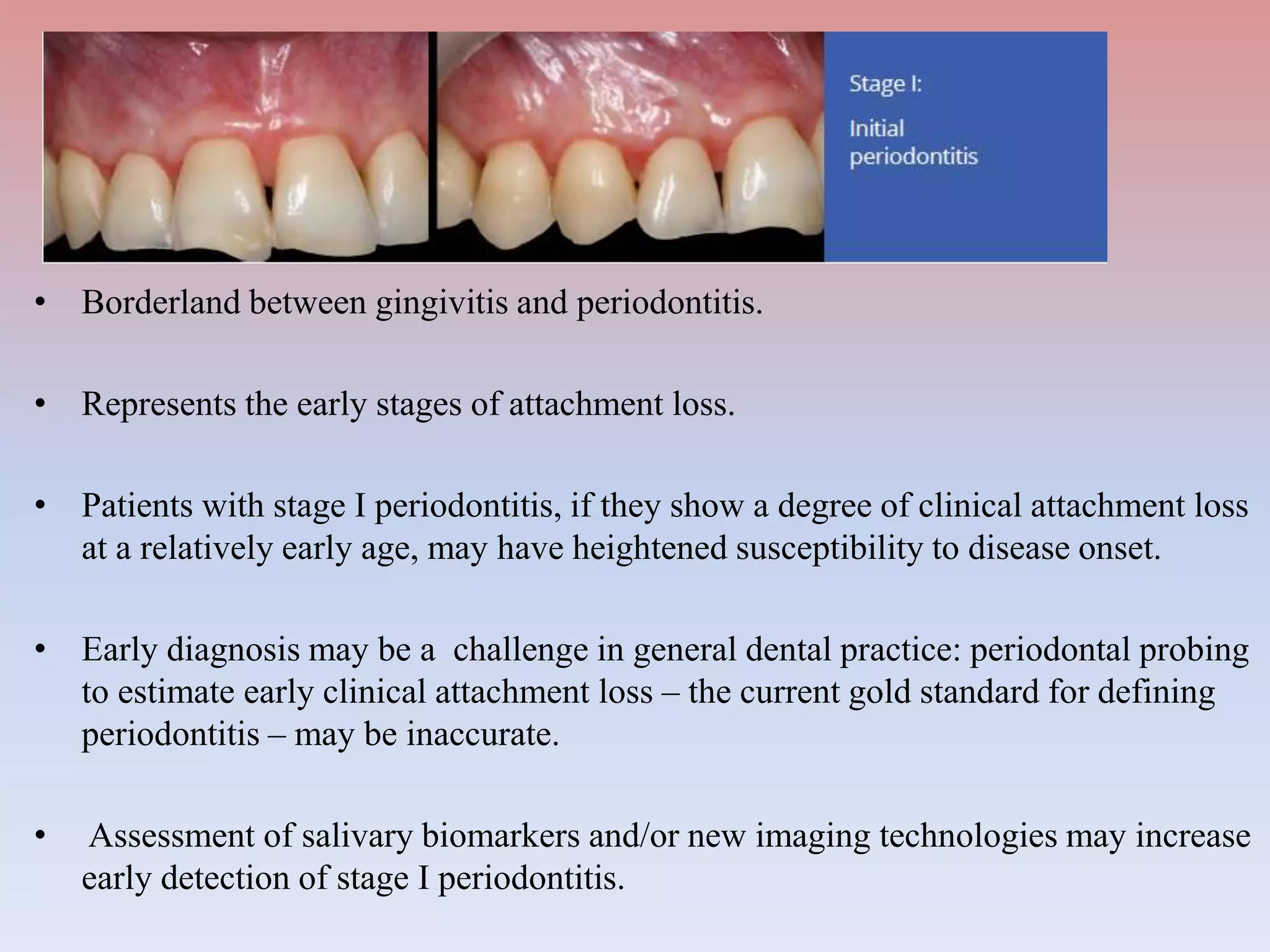 Periodontitis | PPTX