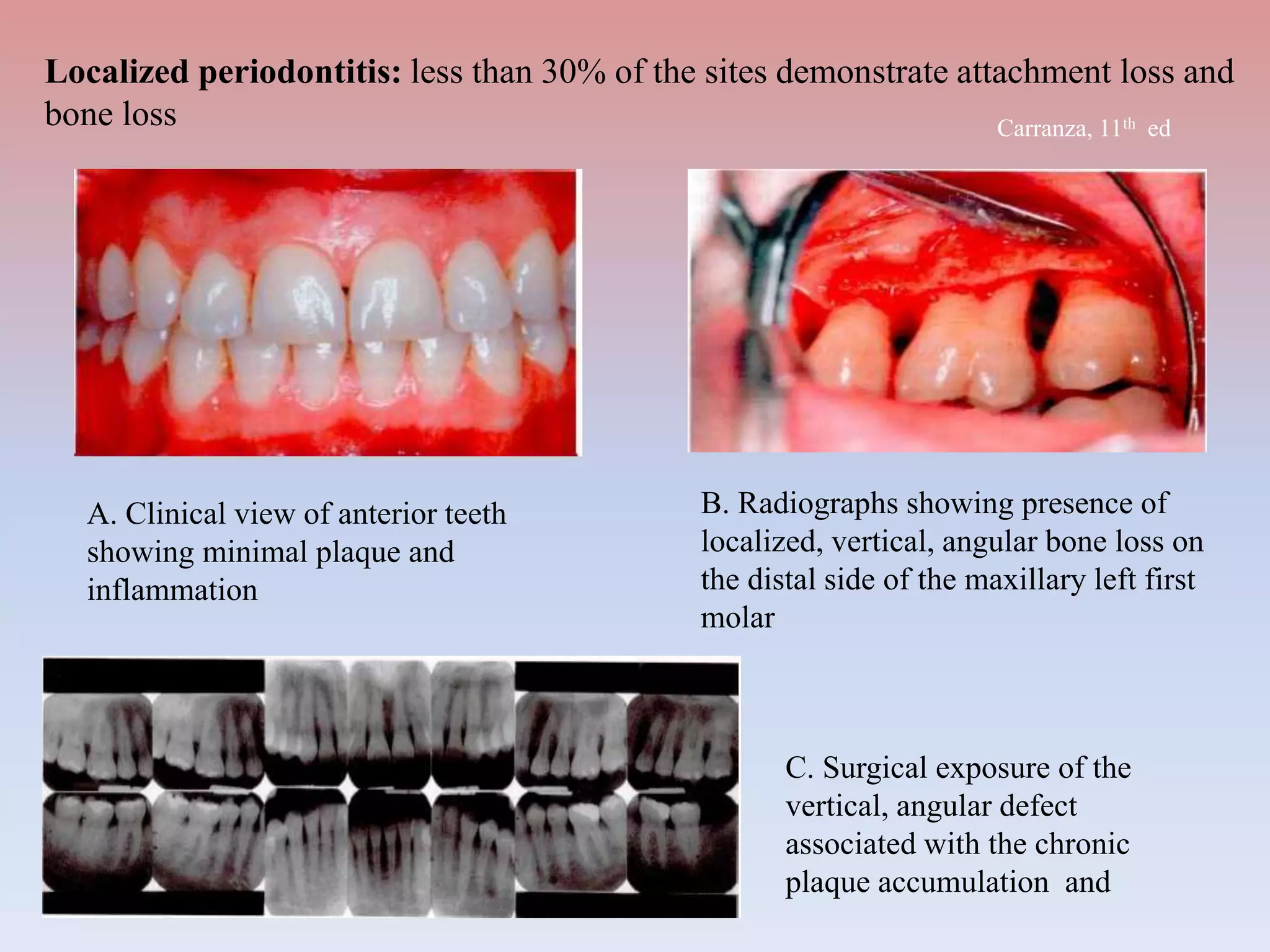 Periodontitis | PPTX
