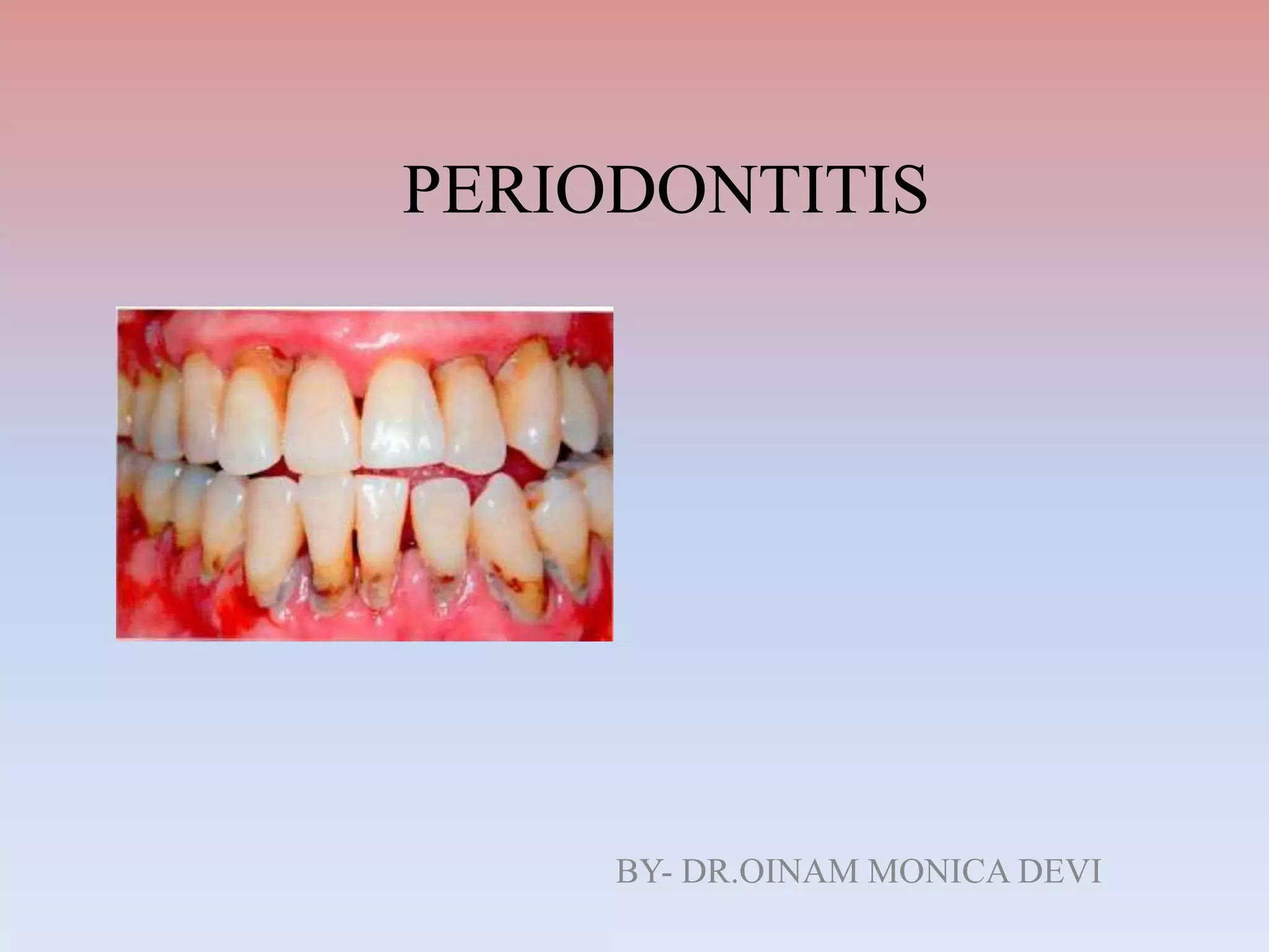 Periodontitis | PPT