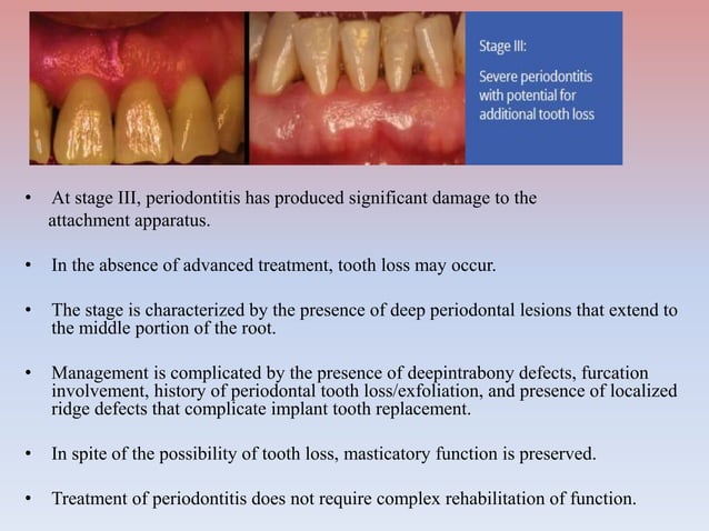 Periodontitis | PPTX | Oral care | Personal Care