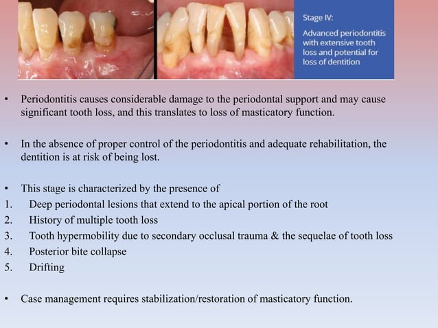 Periodontitis | PPTX | Oral care | Personal Care