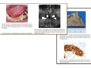 periodontitis-and-oral-cancer.pdf