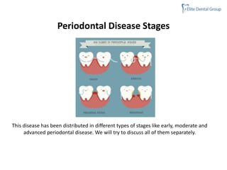 PERIODONTITIS-YOU NEED TO TAKE CARE OF THIS DENTAL DISEASE | PPTX
