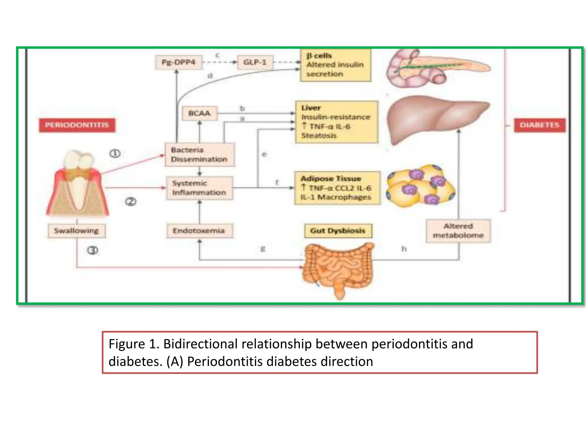 periodontitis and diabetes.pptx