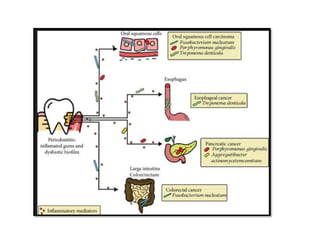 periodontitis and oral cancer.pptx