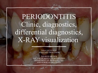 PERIODONTITIS Clinic, diagnostics, differential diagnostics, X-RAY ...