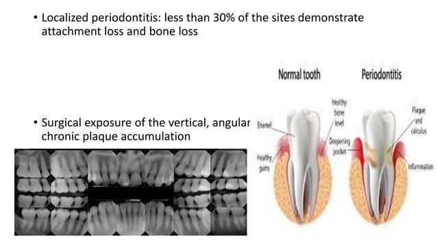 Periodontitis ppt for medical students for dermatology | PPTX | Dental ...