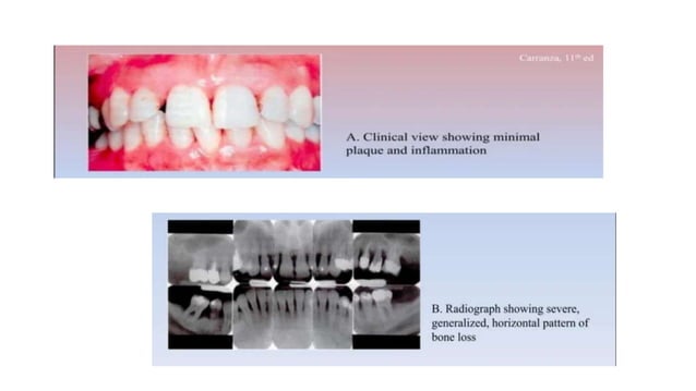 Periodontitis ppt for medical students for dermatology | PPTX | Dental ...