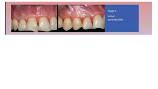 Periodontitis ppt for medical students for dermatology | PPTX | Dental ...