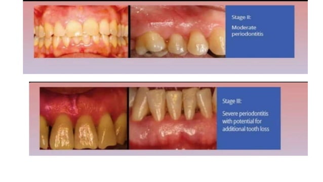 Periodontitis ppt for medical students for dermatology | PPTX | Dental ...