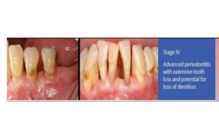 Periodontitis ppt for medical students for dermatology | PPTX | Dental ...