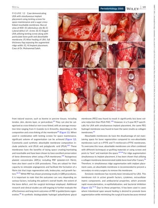Periodontology 2000 - 2023 - Yu - Simultaneous or staged lateral ridge augmentation A clinical ...