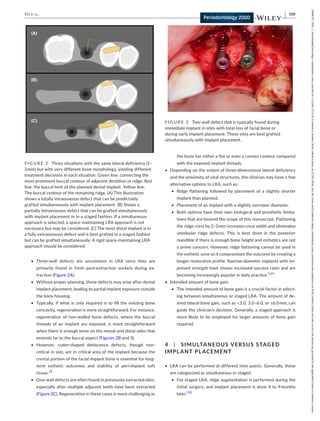 Periodontology 2000 - 2023 - Yu - Simultaneous or staged lateral ridge ...