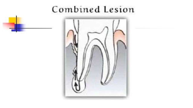 Perio endo lesion ojus