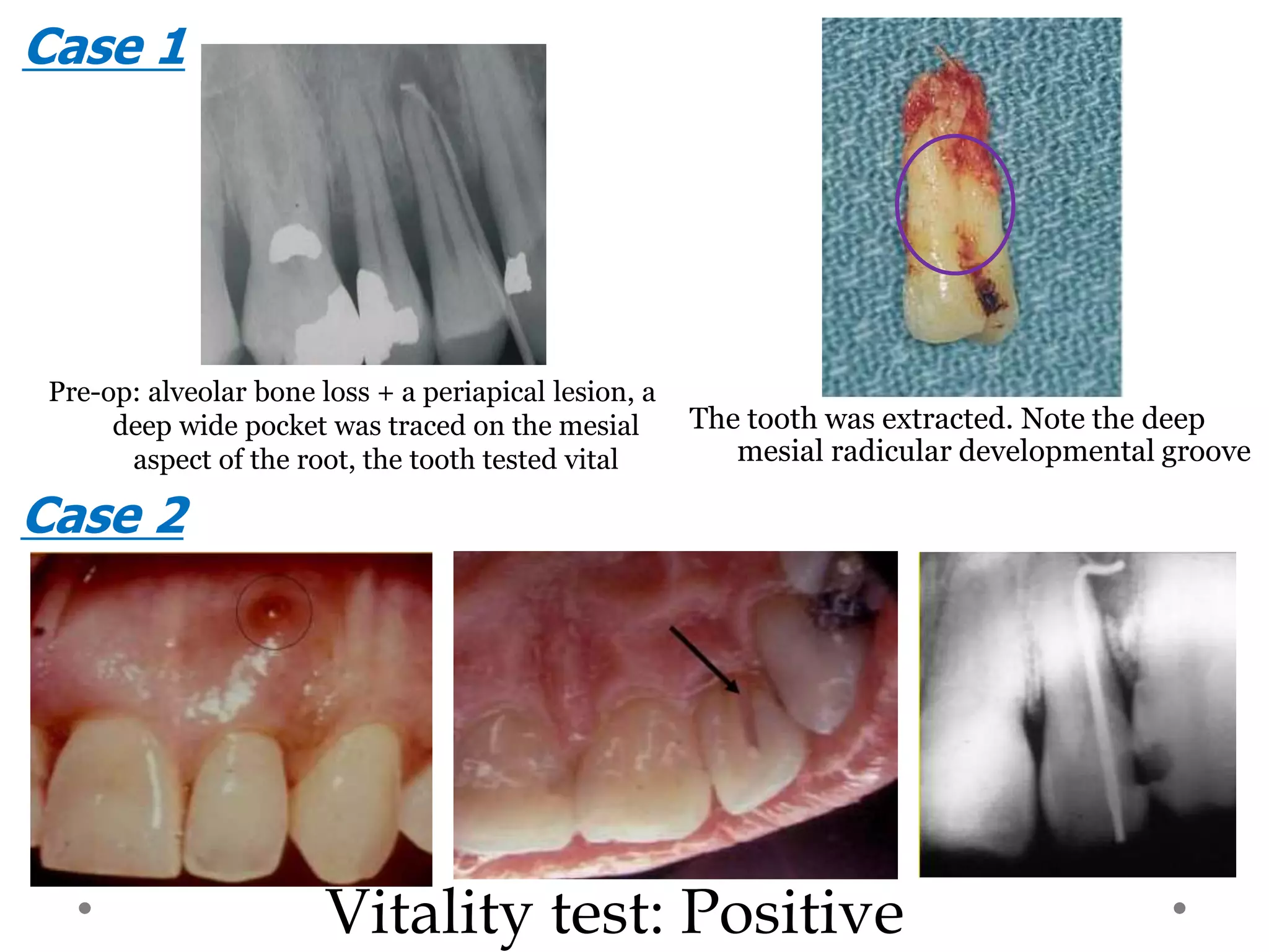 Periodontal endodontic lesions | PPTX
