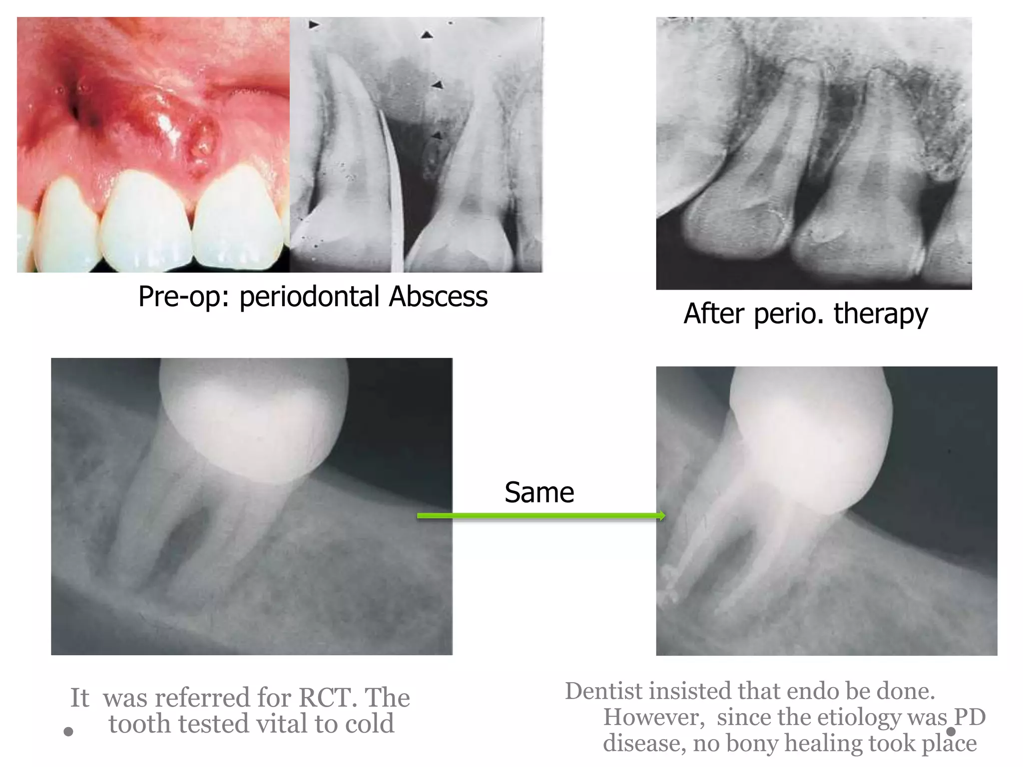 Periodontal endodontic lesions | PPTX