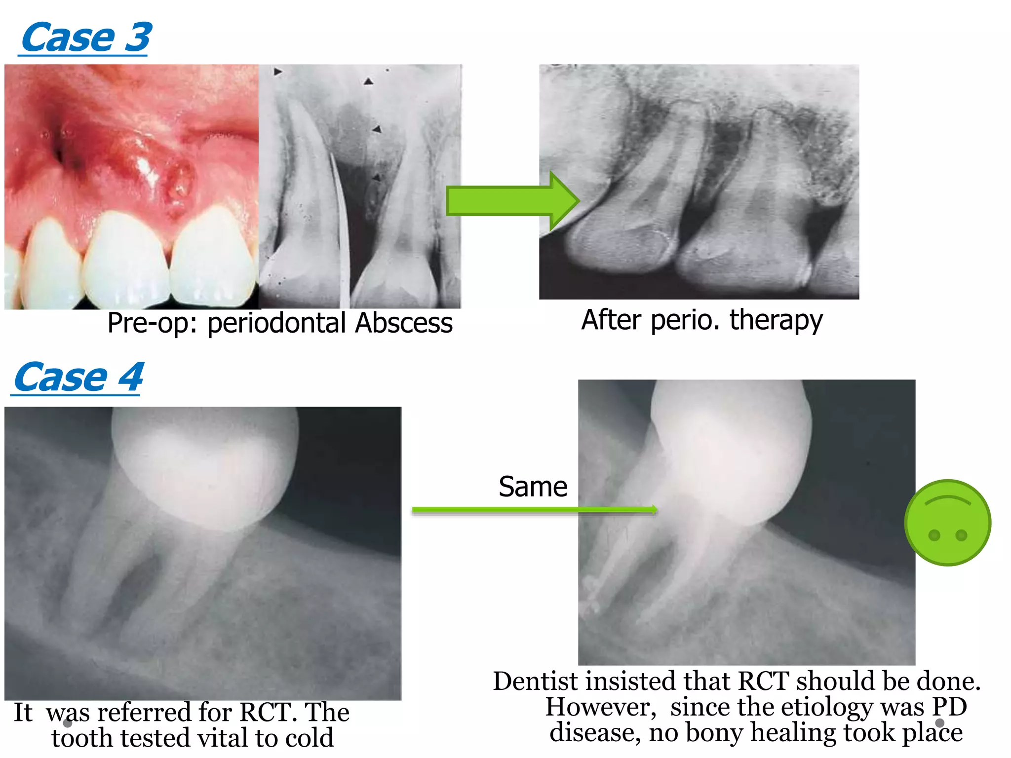 Periodontal endodontic lesions | PPTX