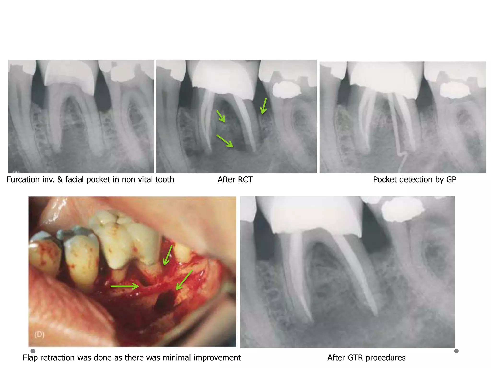 Periodontal endodontic lesions | PPTX