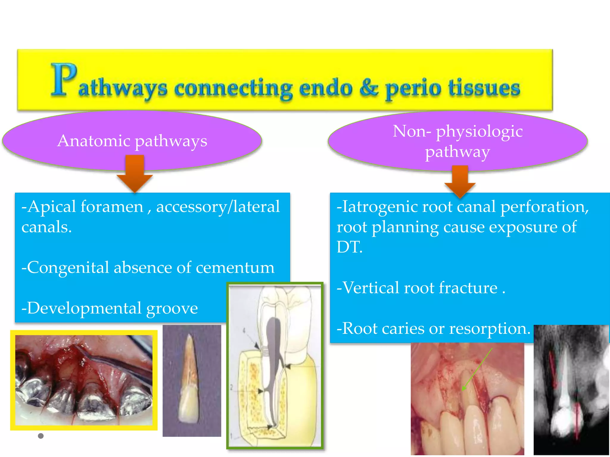 Periodontal endodontic lesions | PPTX
