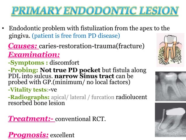 Periodontal endodontic lesions | PPTX | Dental Health | Diseases and ...