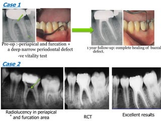 Periodontal endodontic lesions | PPTX