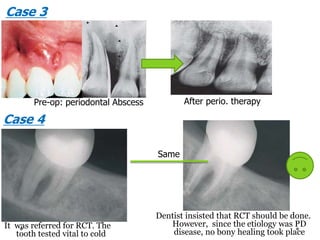 Periodontal endodontic lesions | PPTX