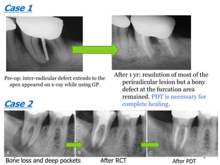 Periodontal endodontic lesions | PPTX