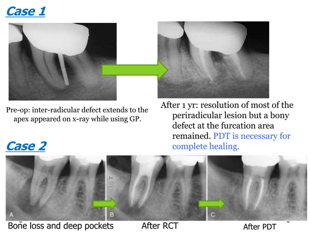 Periodontal endodontic lesions | PPTX | Dental Health | Diseases and ...