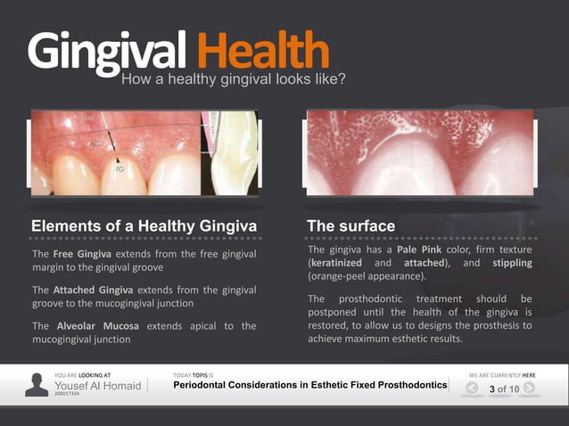Periodontal Esthetic Considerations in Fixed Prosthodontics | PPTX