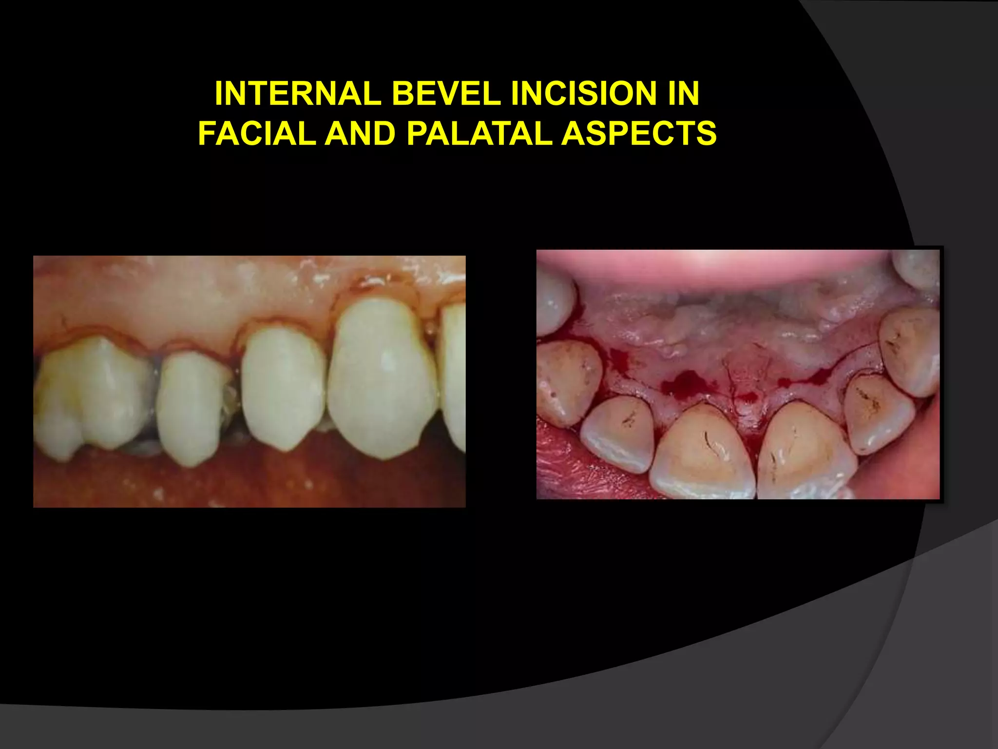 periodontal flap techniques | PPTX