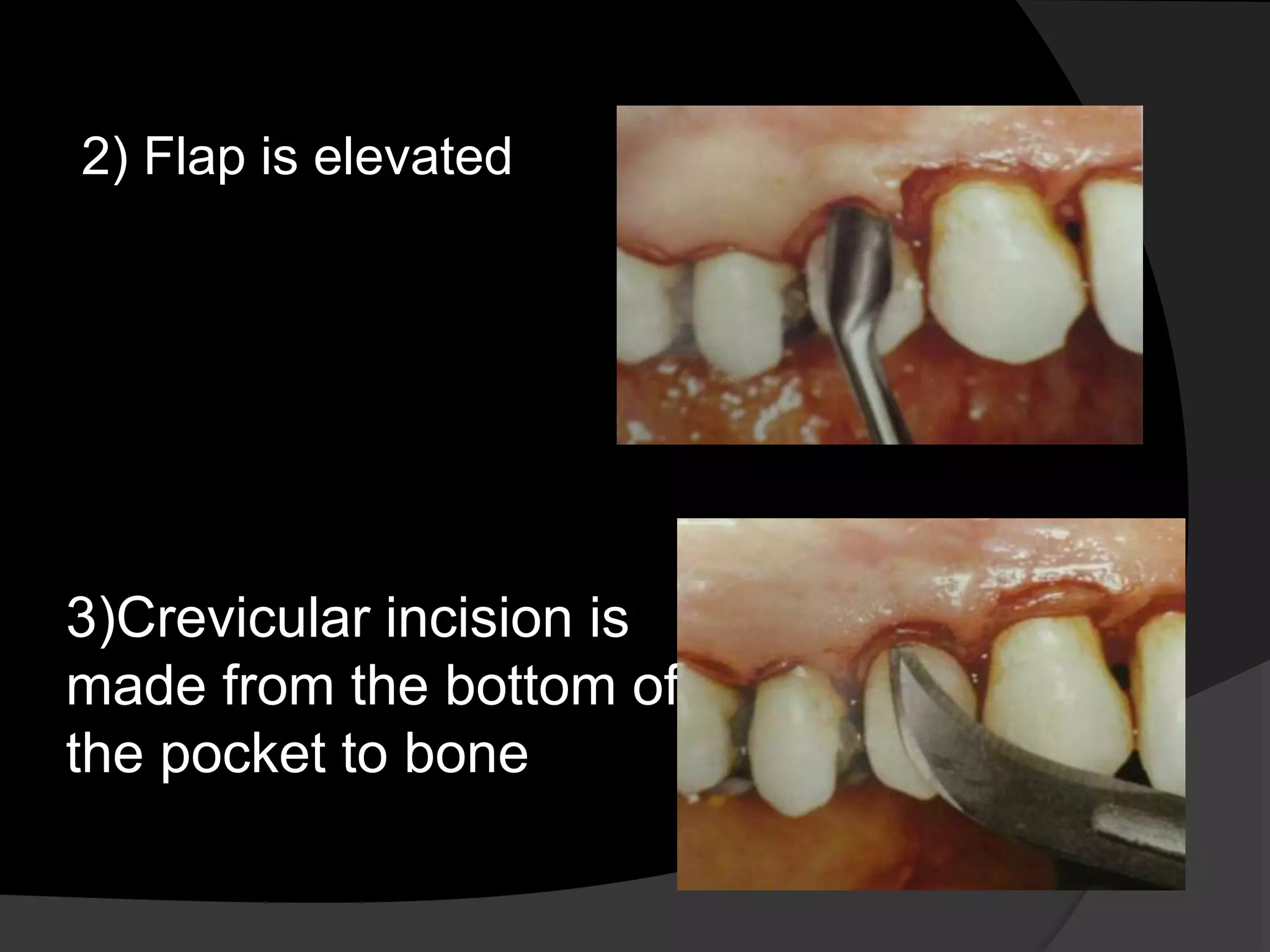 periodontal flap techniques | PPTX