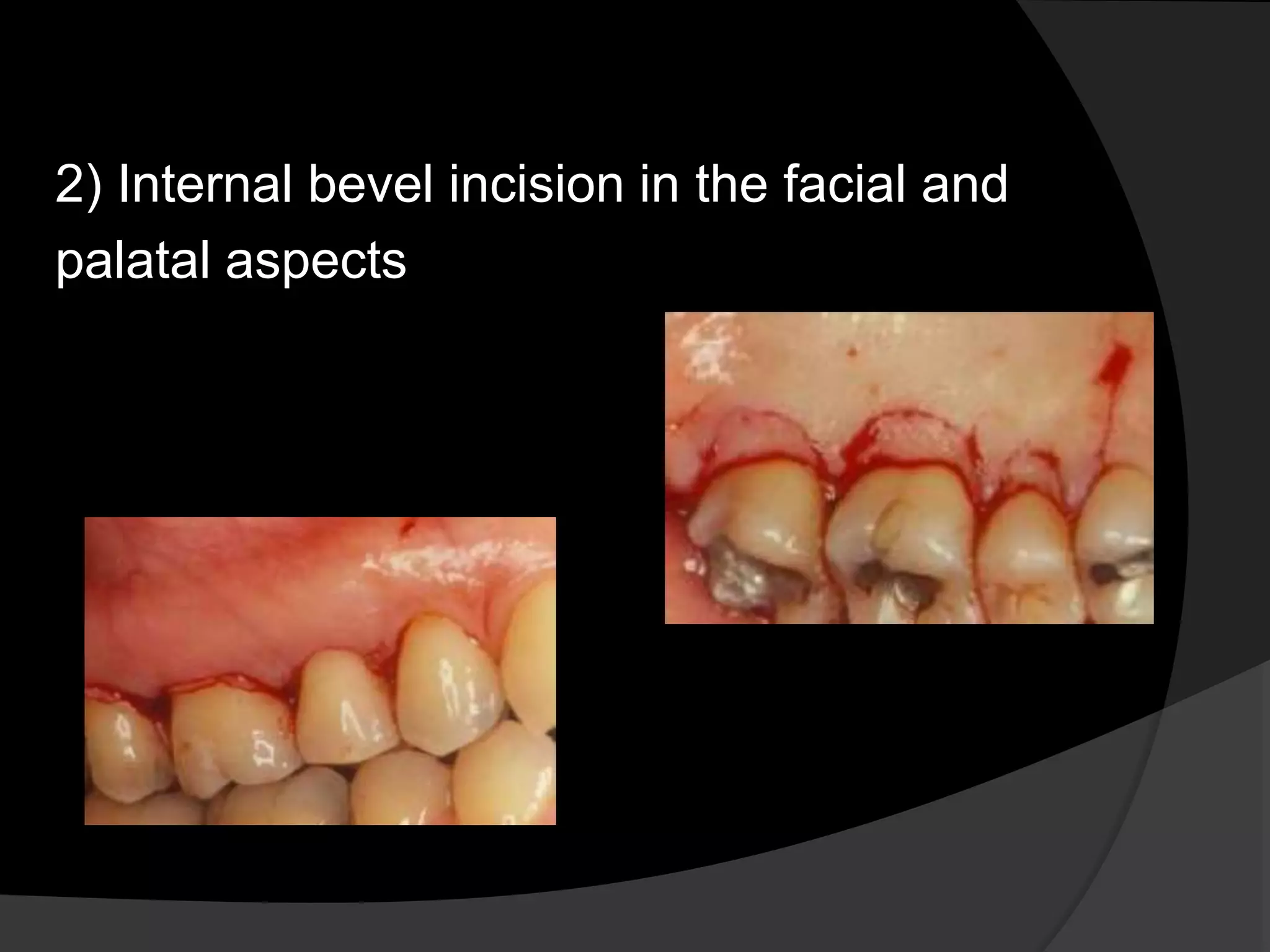 periodontal flap techniques | PPTX
