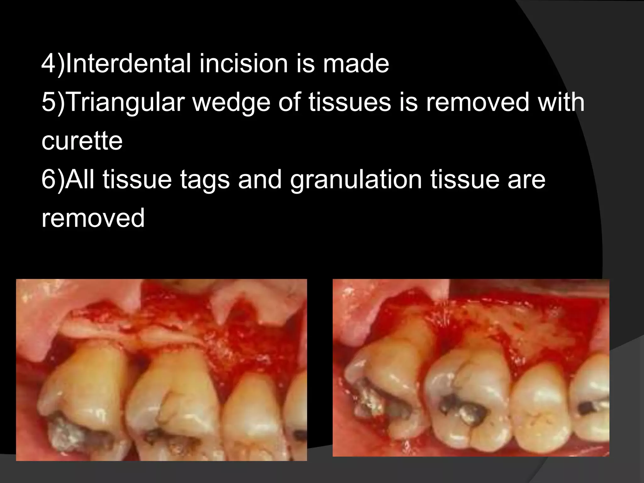 periodontal flap techniques | PPTX