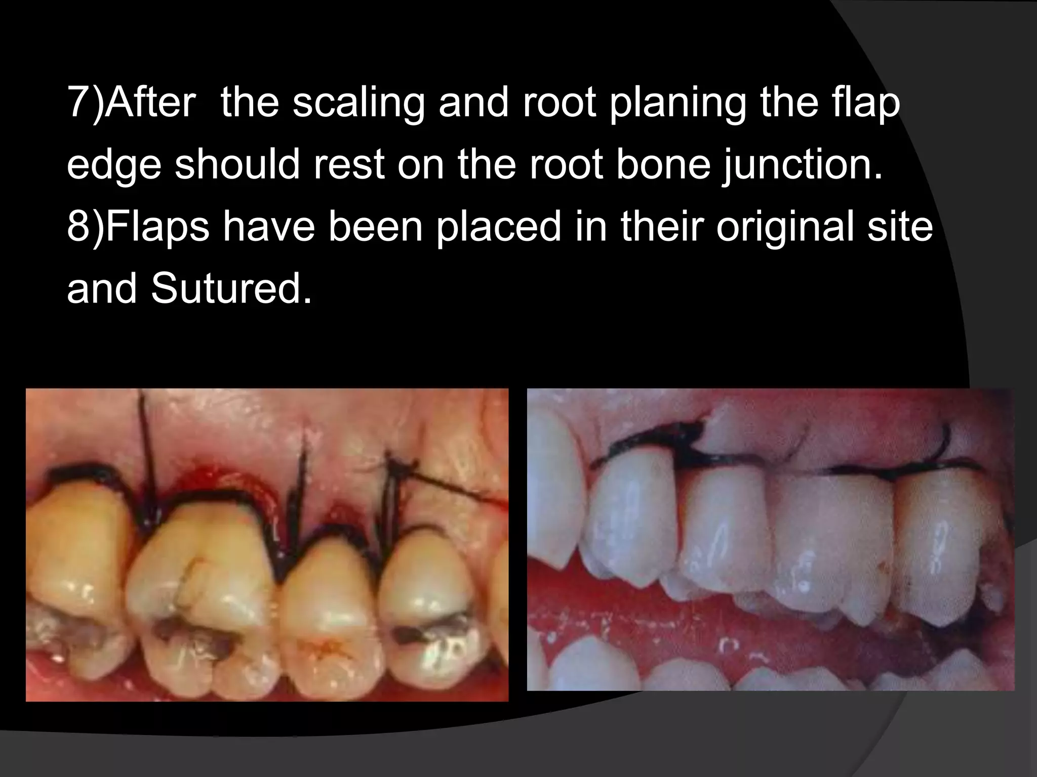 periodontal flap techniques | PPTX