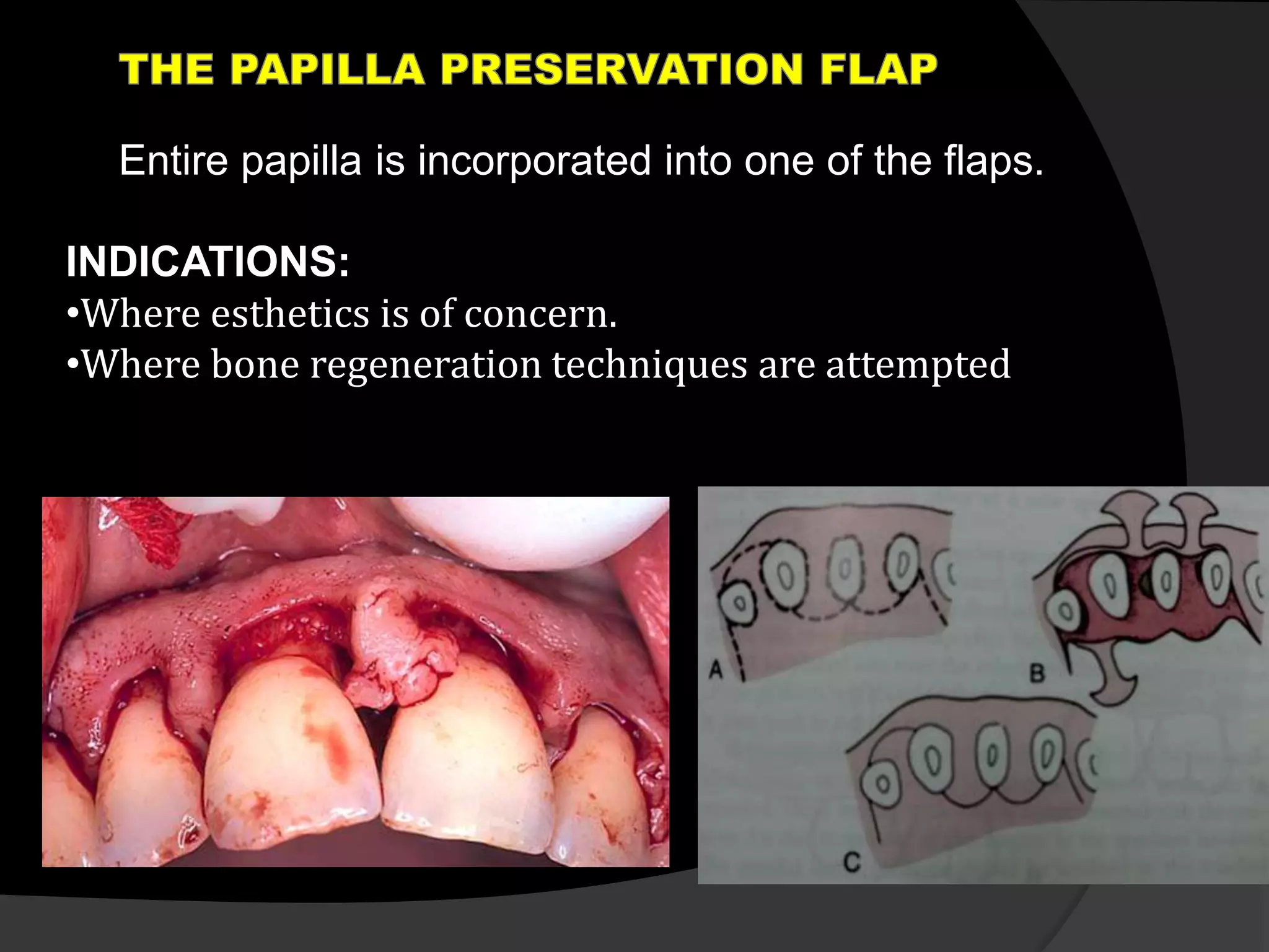 periodontal flap techniques | PPTX