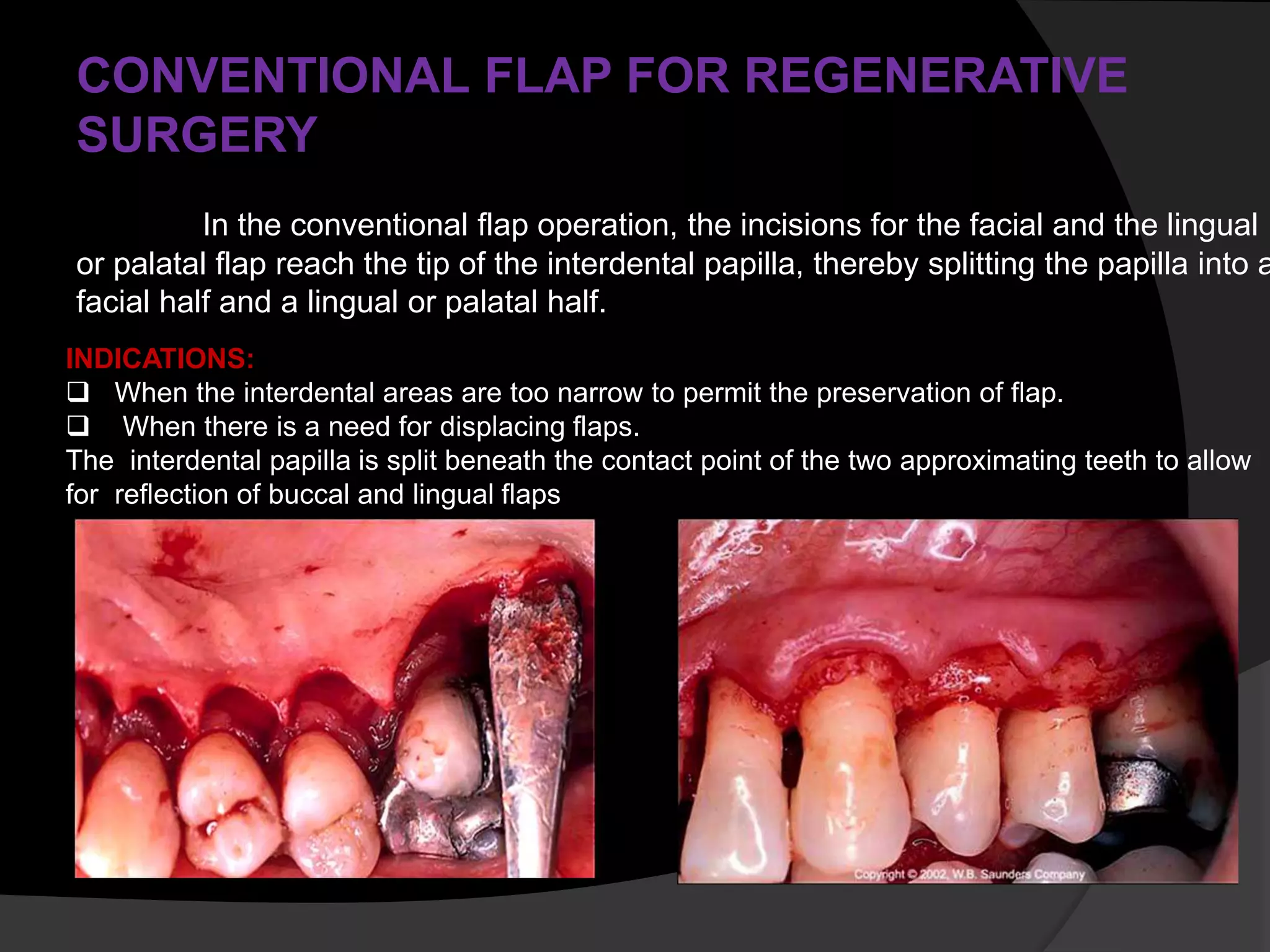 periodontal flap techniques | PPTX