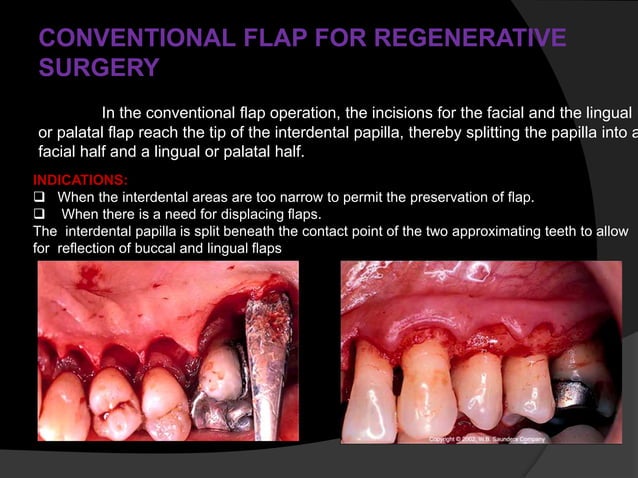 periodontal flap techniques | PPTX | Oral care | Personal Care