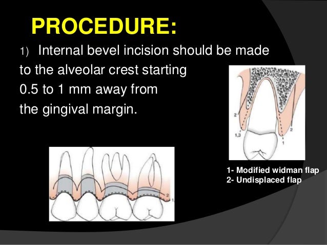periodontal flap techniques