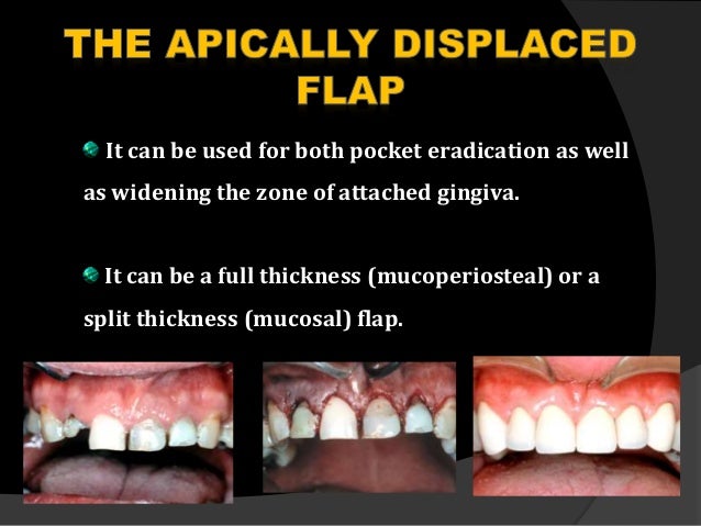 periodontal flap techniques