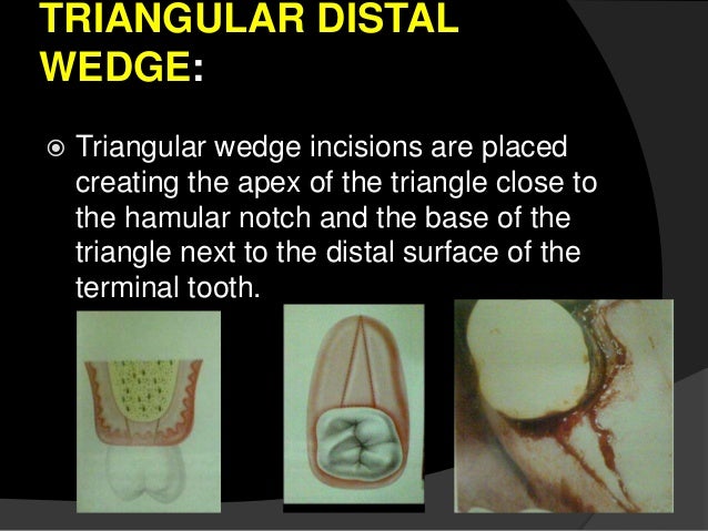 periodontal flap techniques
