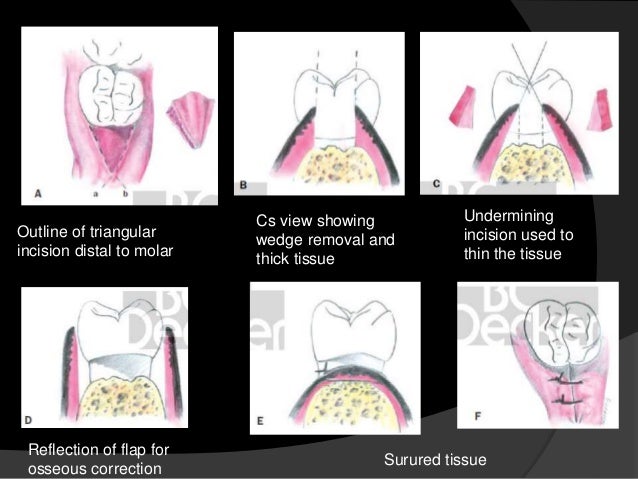 periodontal flap techniques