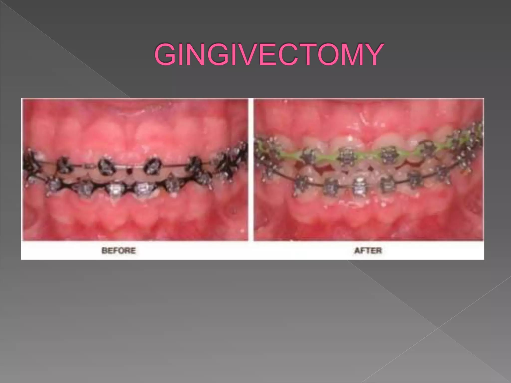 PERIO – ORTHO RELATIONSHIP.pptx