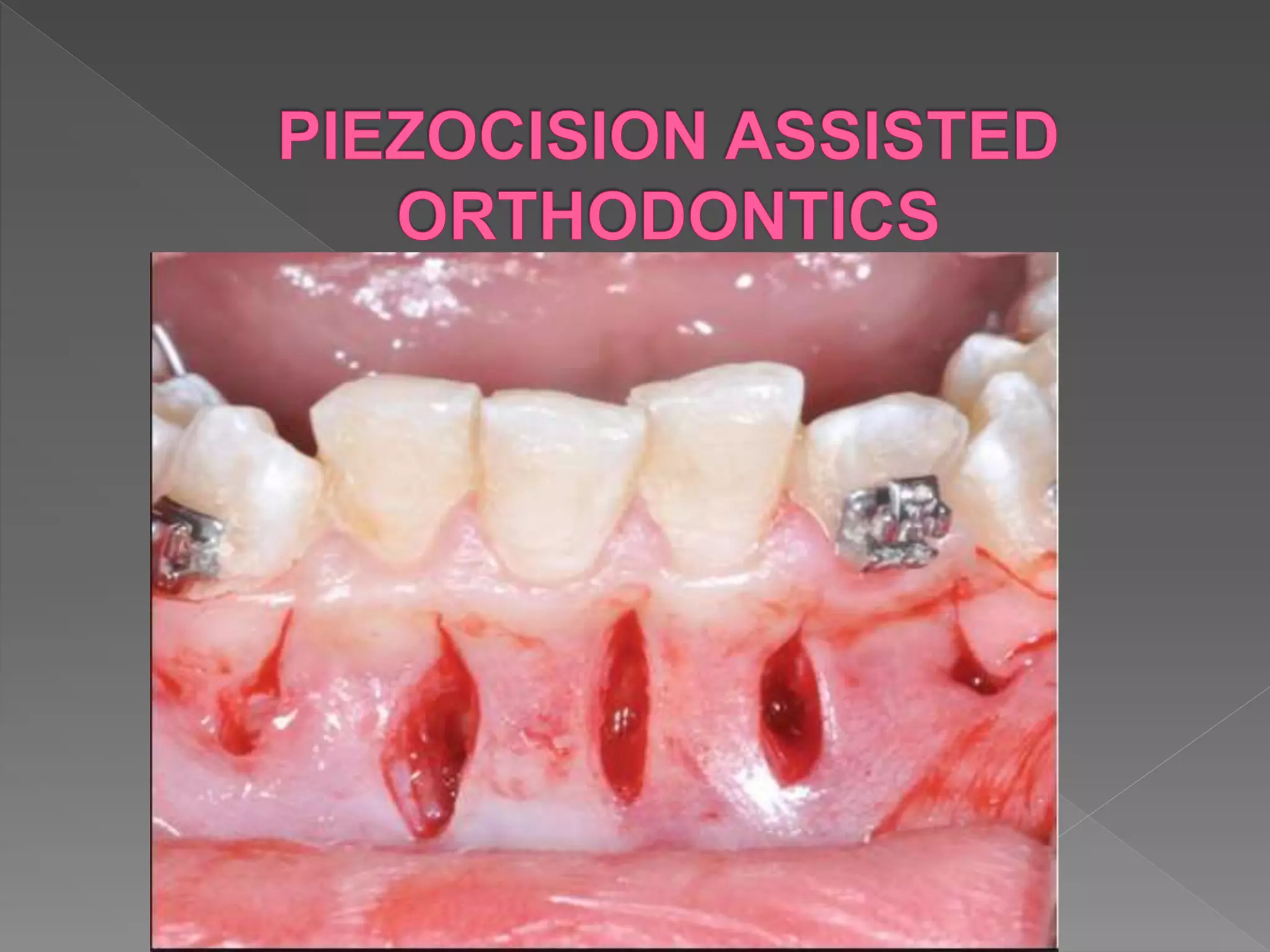 PERIO – ORTHO RELATIONSHIP.pptx