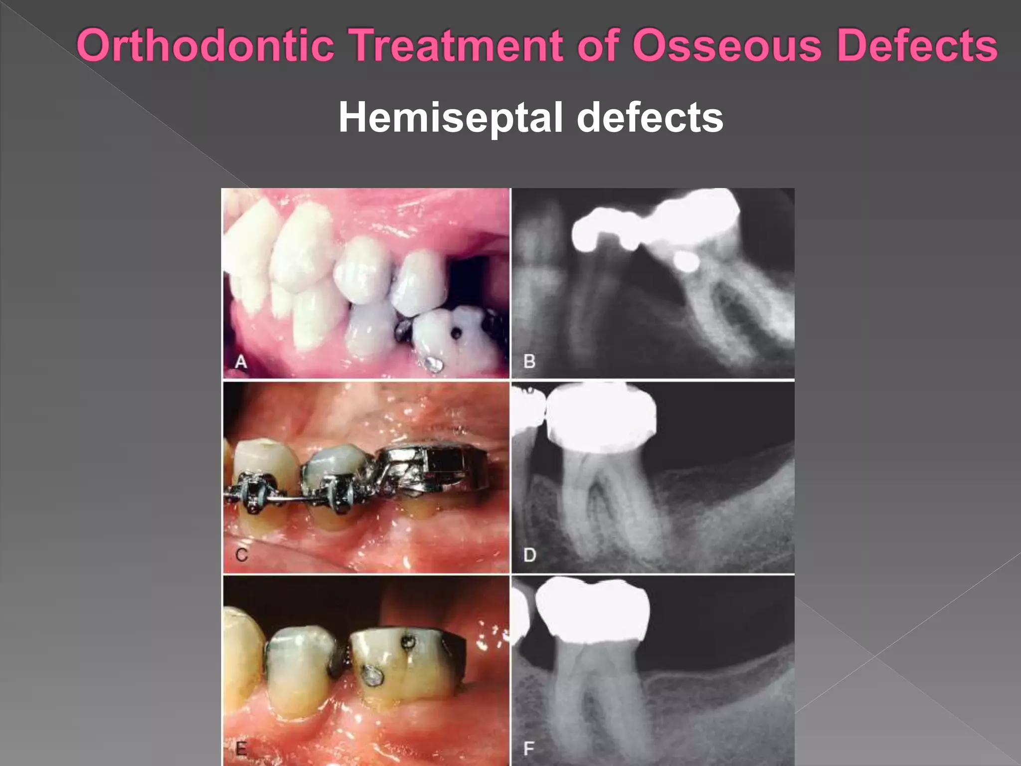 PERIO – ORTHO RELATIONSHIP.pptx